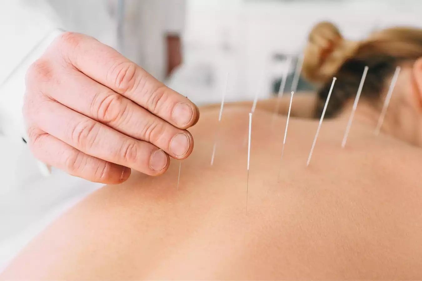 Acupuncture and pregnancy: the benefits – Laboratoires Téane-Althéa Lab